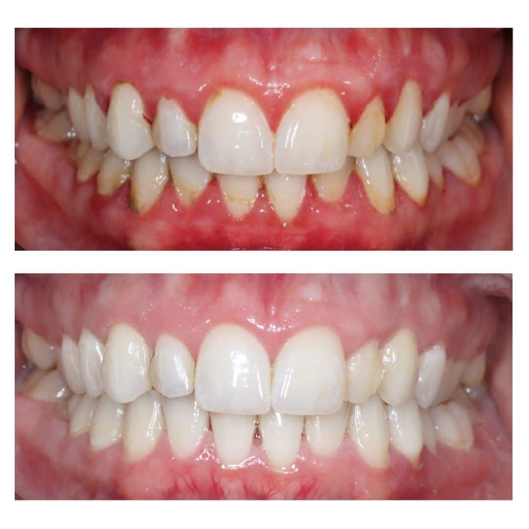 Healthy Gums Vs Receding Gums Healthy Gums Vs Receding Gums