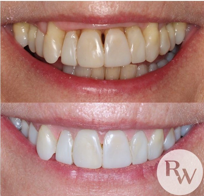 Gum Veneer - RW Perio
