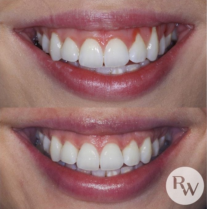 Preventive - RW Perio